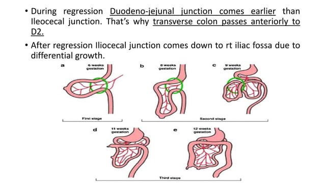 childhood intestinal obstruction.pptx