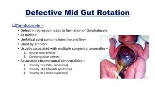 childhood intestinal obstruction.pptx