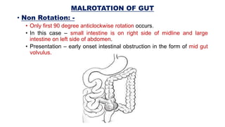 childhood intestinal obstruction.pptx | Pregnancy | Reproductive Health