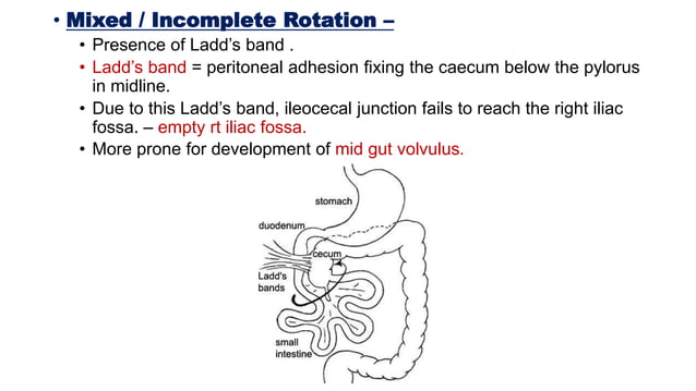 childhood intestinal obstruction.pptx