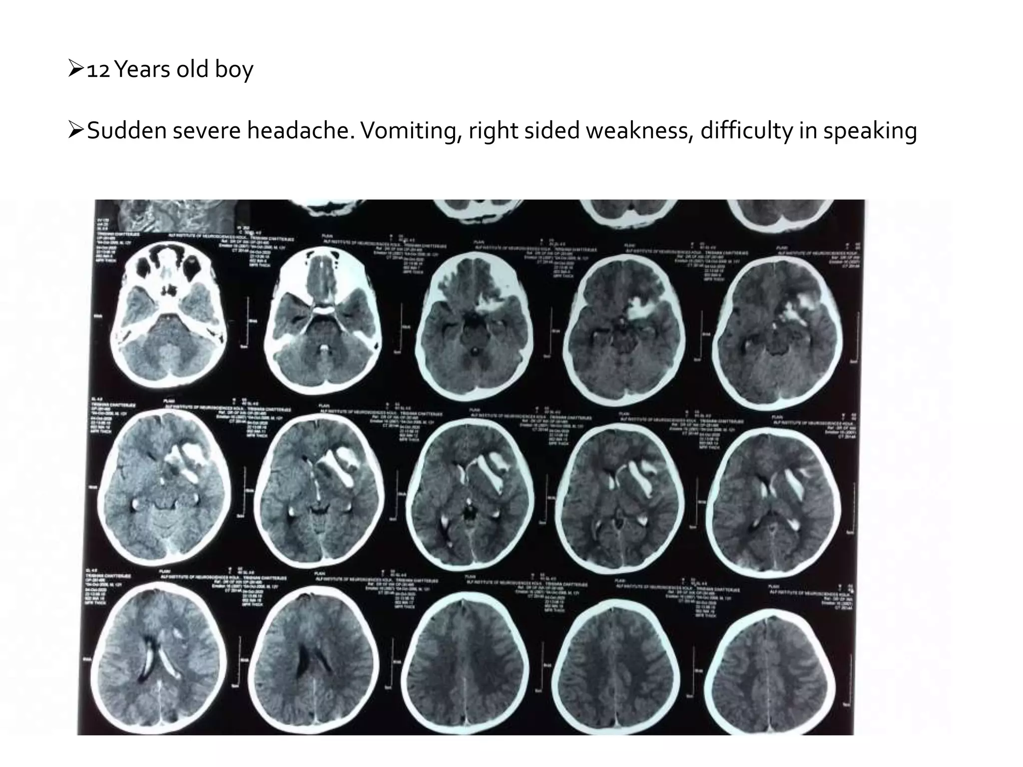 Childhood intracranial aneurysms | PPT