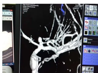 Childhood intracranial aneurysms | PPT