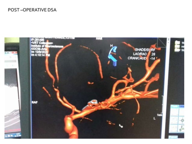 Childhood intracranial aneurysms | PPT