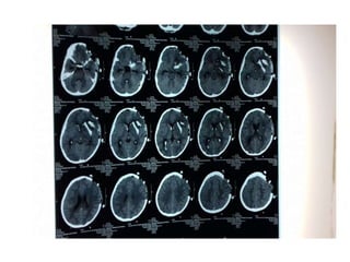 Childhood intracranial aneurysms | PPT