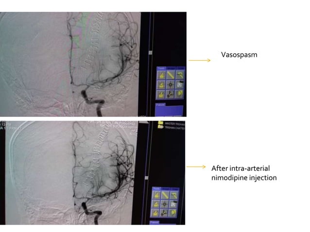 Childhood intracranial aneurysms | PPT
