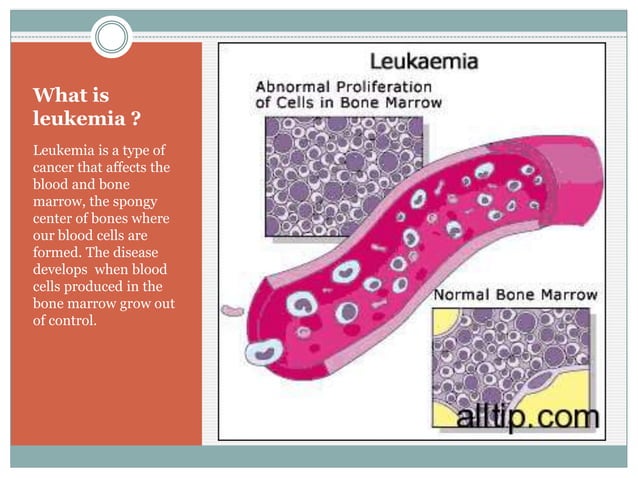 leukemia | PPTX | Blood Disorders | Diseases and Conditions