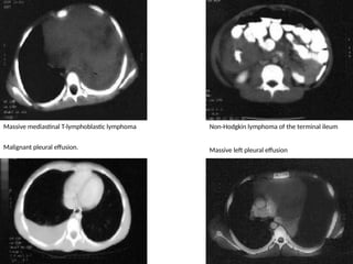 Childhood Lymphomas classification .pptx