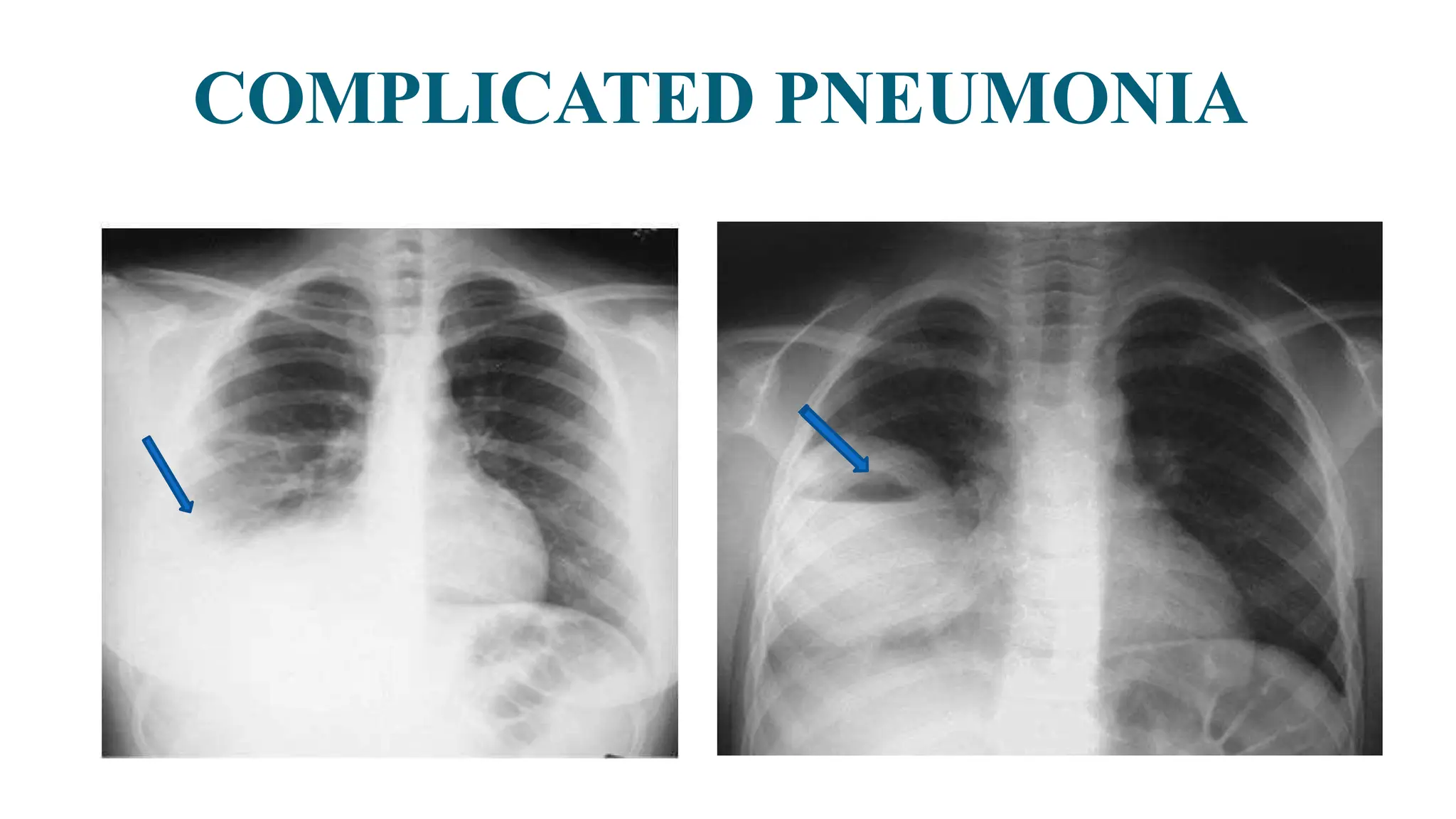 childhood_Pneumonia-compressed final.pptx