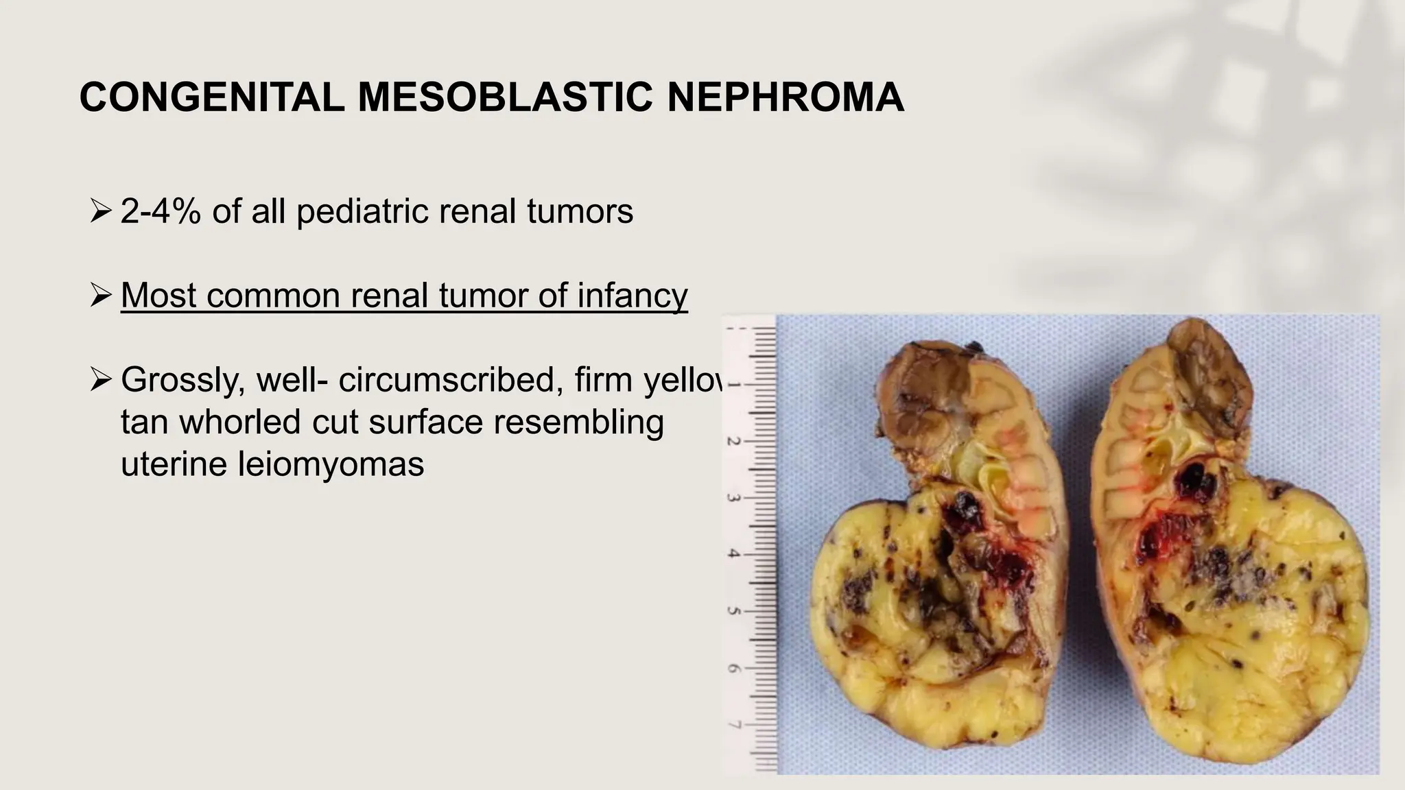 CHILDHOOD RENAL TUMORS.pptx Pediatric renal pathology | PPTX