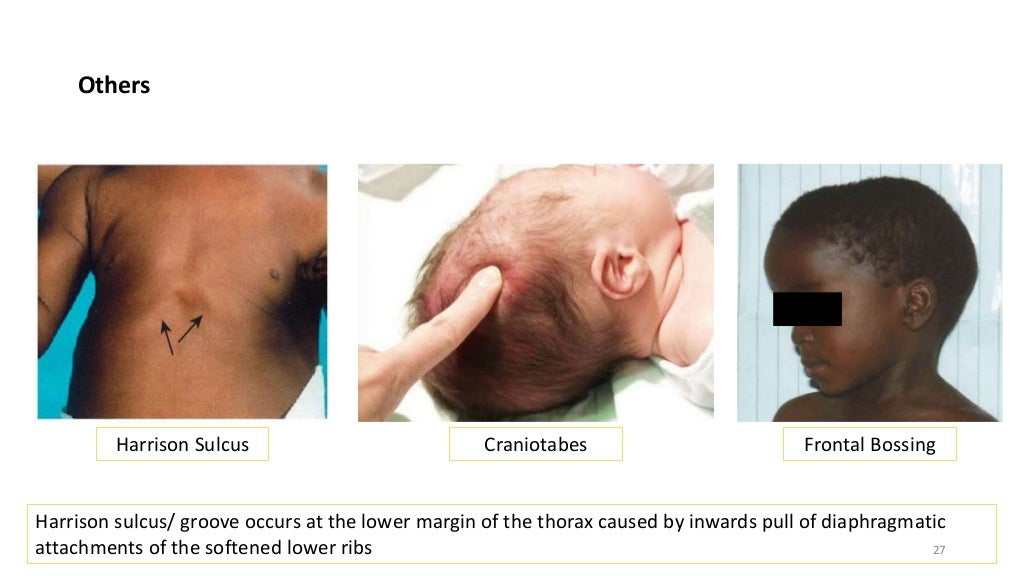 An Overview of Childhood Rickets