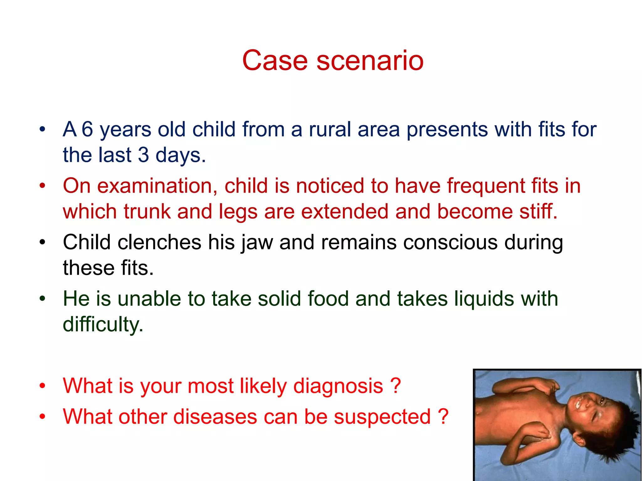 Childhood tetanus 2021 | PDF