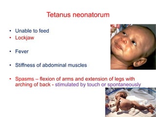 Childhood tetanus 2021 | PDF