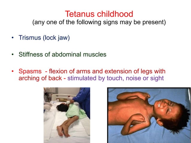 Childhood tetanus 2021 | PDF