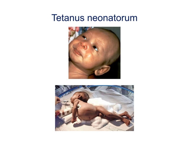 Childhood tetanus 2021 | PDF