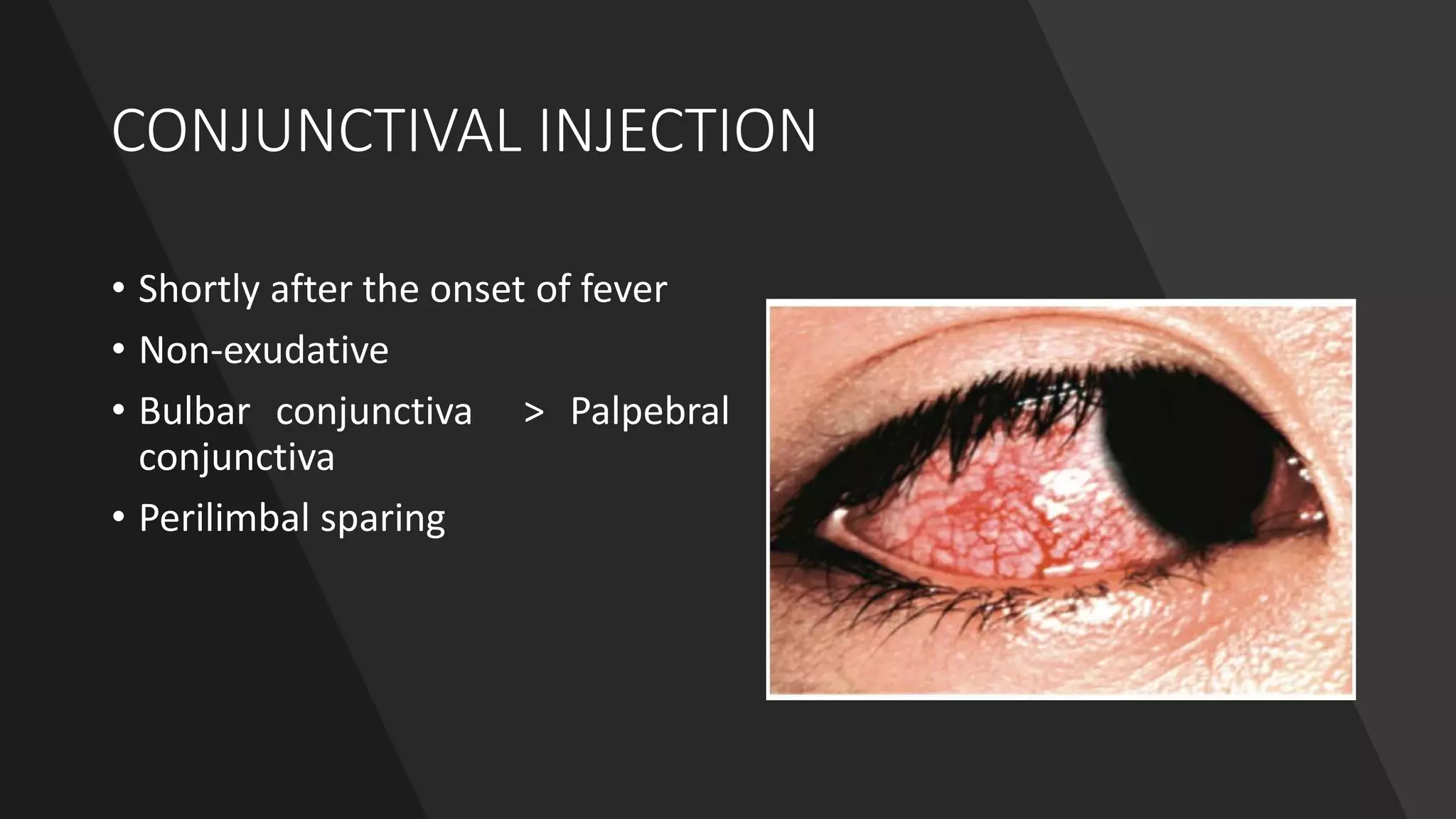 Childhood vasculitis - KD, HSP and other vasculitic syndromes | PPTX
