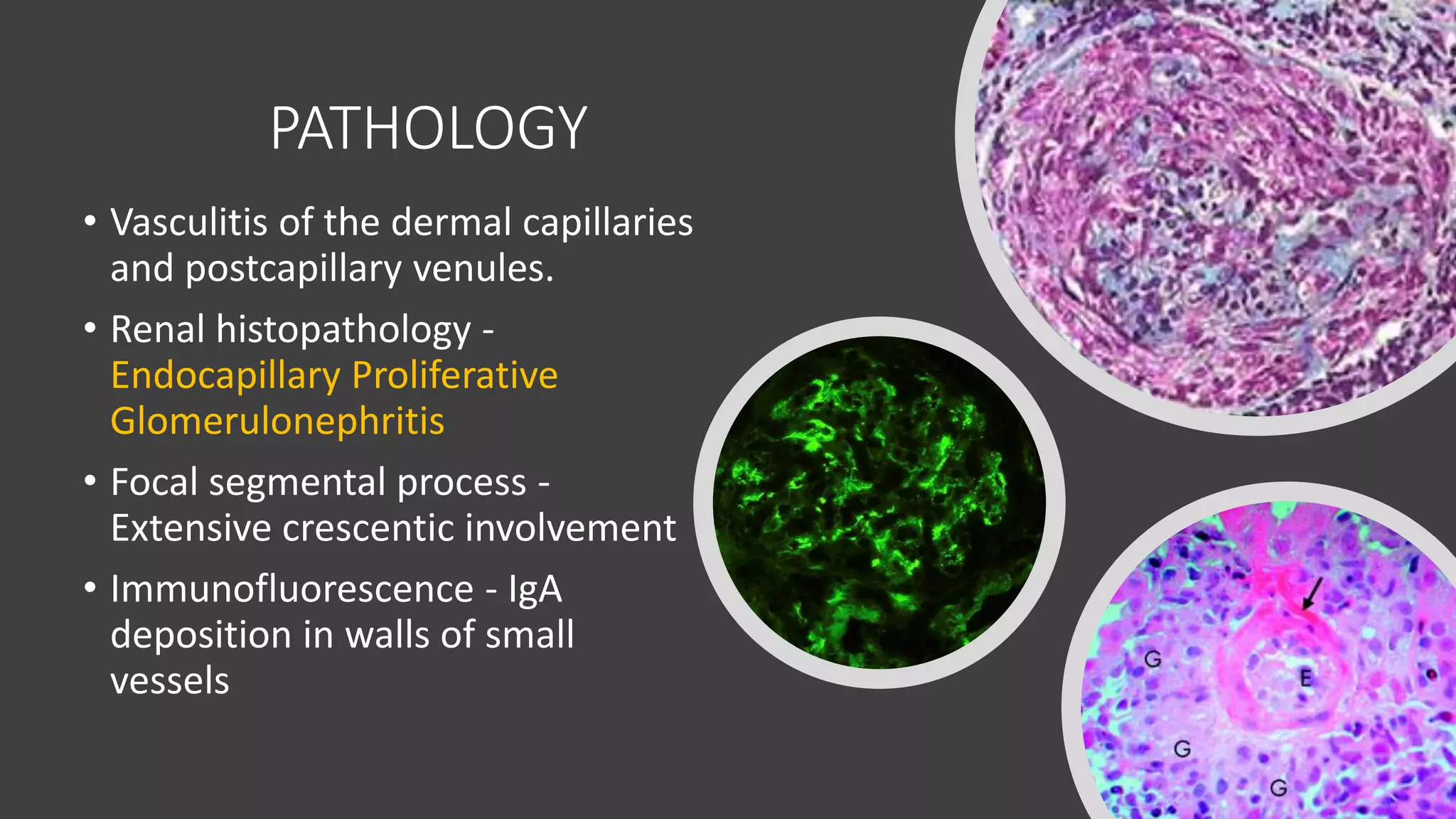 Childhood vasculitis - KD, HSP and other vasculitic syndromes | PPTX