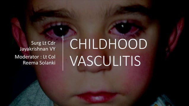 Childhood vasculitis - KD, HSP and other vasculitic syndromes | PPTX ...