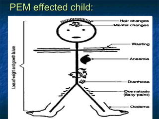 Child nutrition | PPT