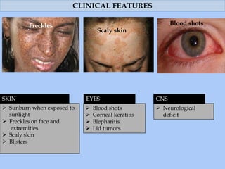 Children of the dark- XERODERMA PIGMENTOSUM | PPTX