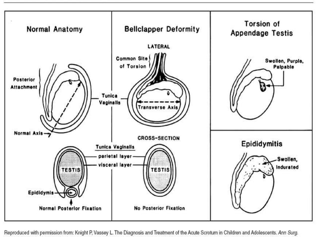 Child with acute scrotum | PPTX