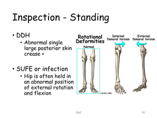 Child with a limp | PPT | Free Download