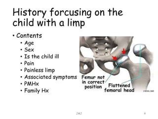 Child with a limp | PPTX