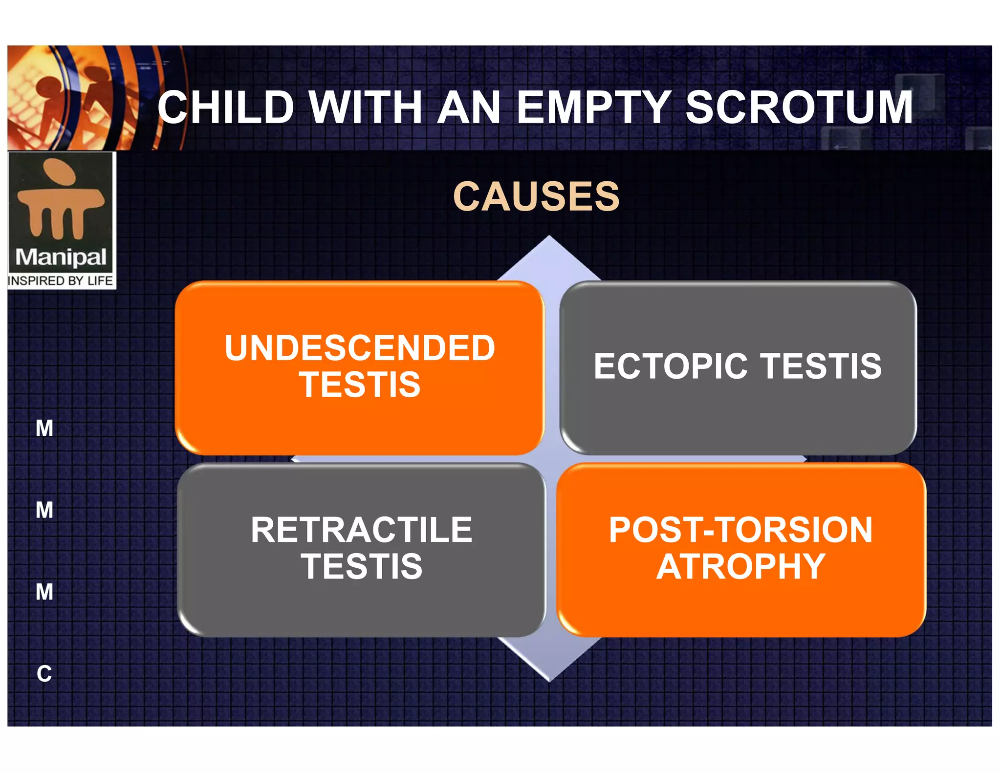 Cryptorchidism--(Undescended testis) | PDF
