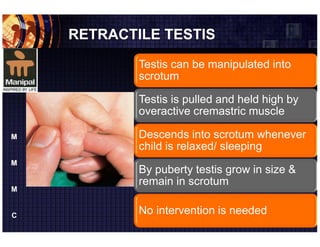 Cryptorchidism--(Undescended testis) | PDF