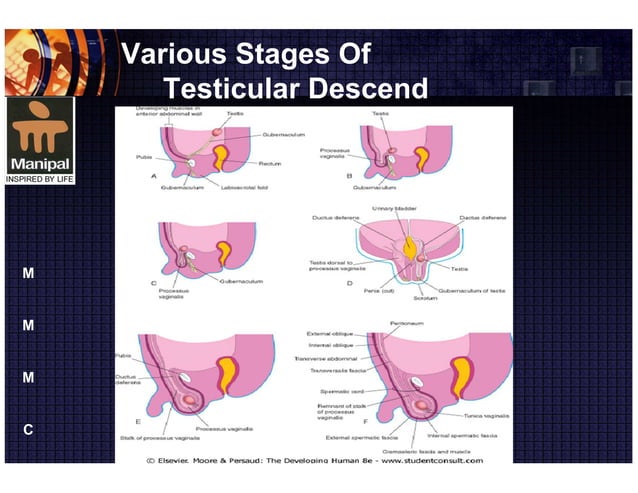 Cryptorchidism--(Undescended testis) | PDF