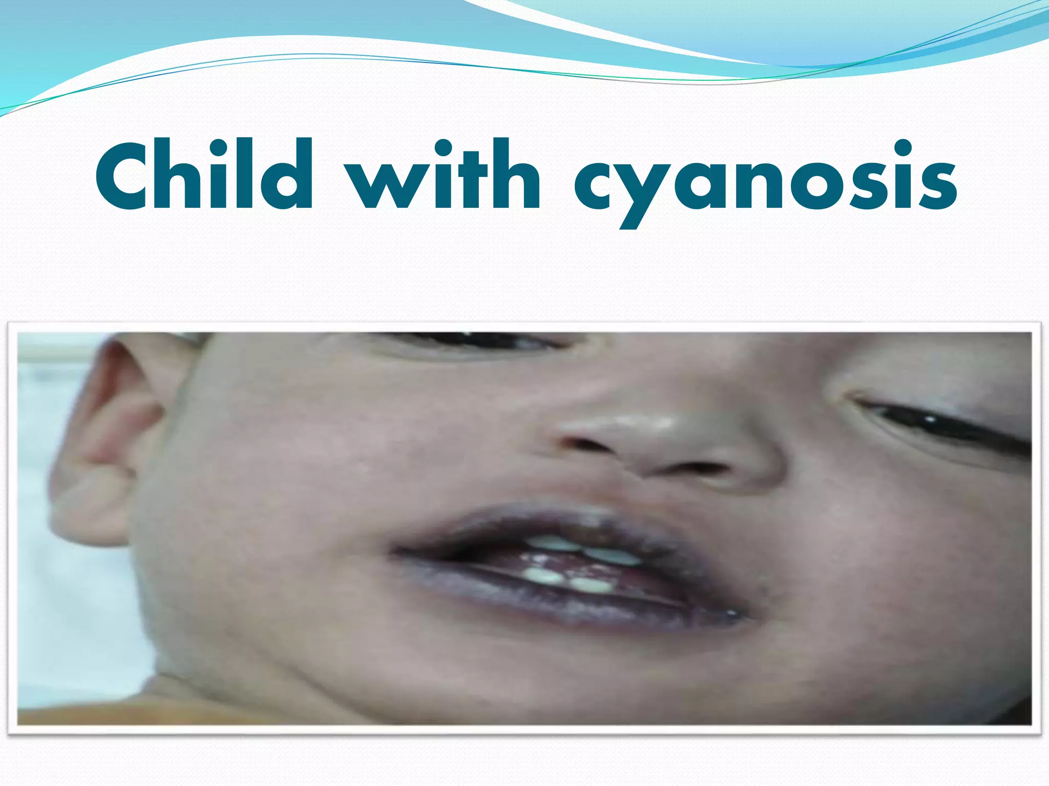 Child with cyanosis | PPTX