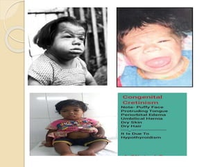 Child with enendocrine disorders | PPTX