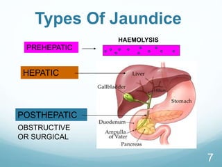 Child with jaundice | PPTX
