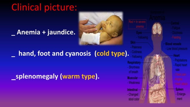 Child with pallor & jaundice (hemolytic anemia) | PPT