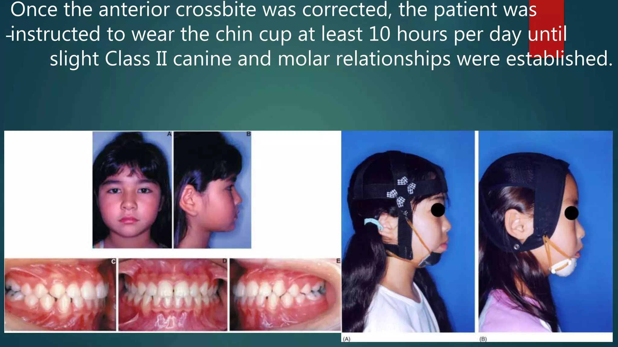 Chin cup for treatment of growing class III patient | PPTX