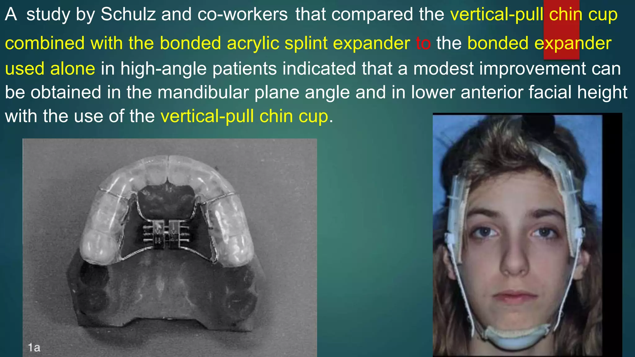 Chin cup for treatment of growing class III patient | PPTX