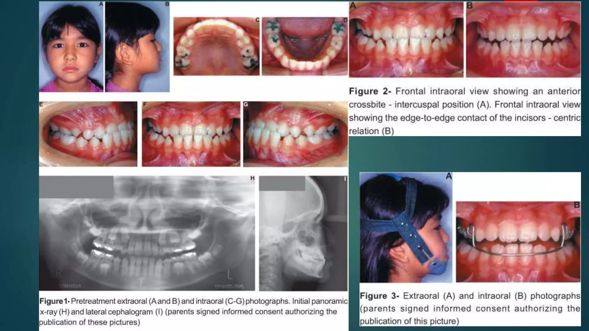 Chin cup for treatment of growing class III patient | PPTX