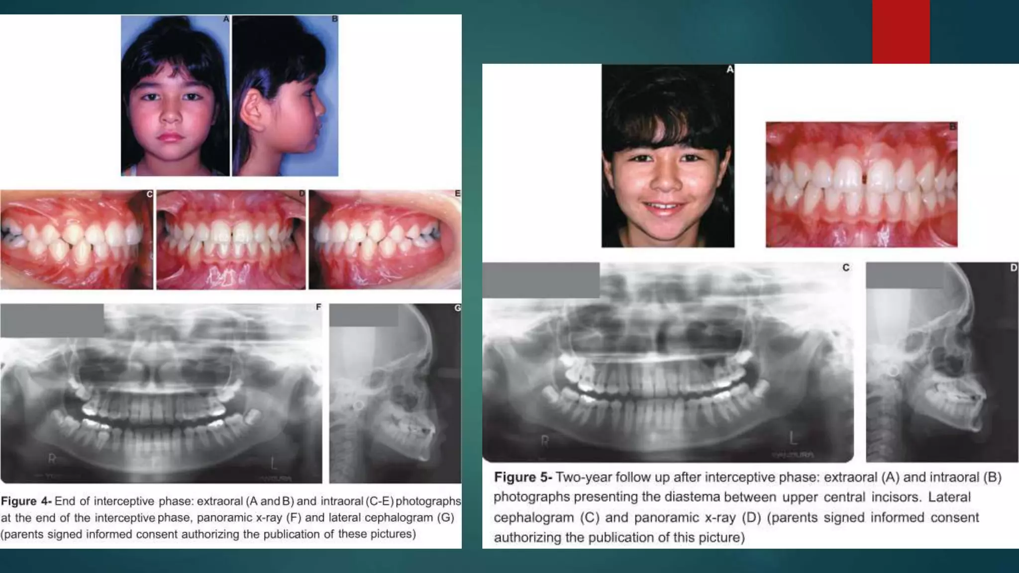 Chin cup for treatment of growing class III patient | PPTX
