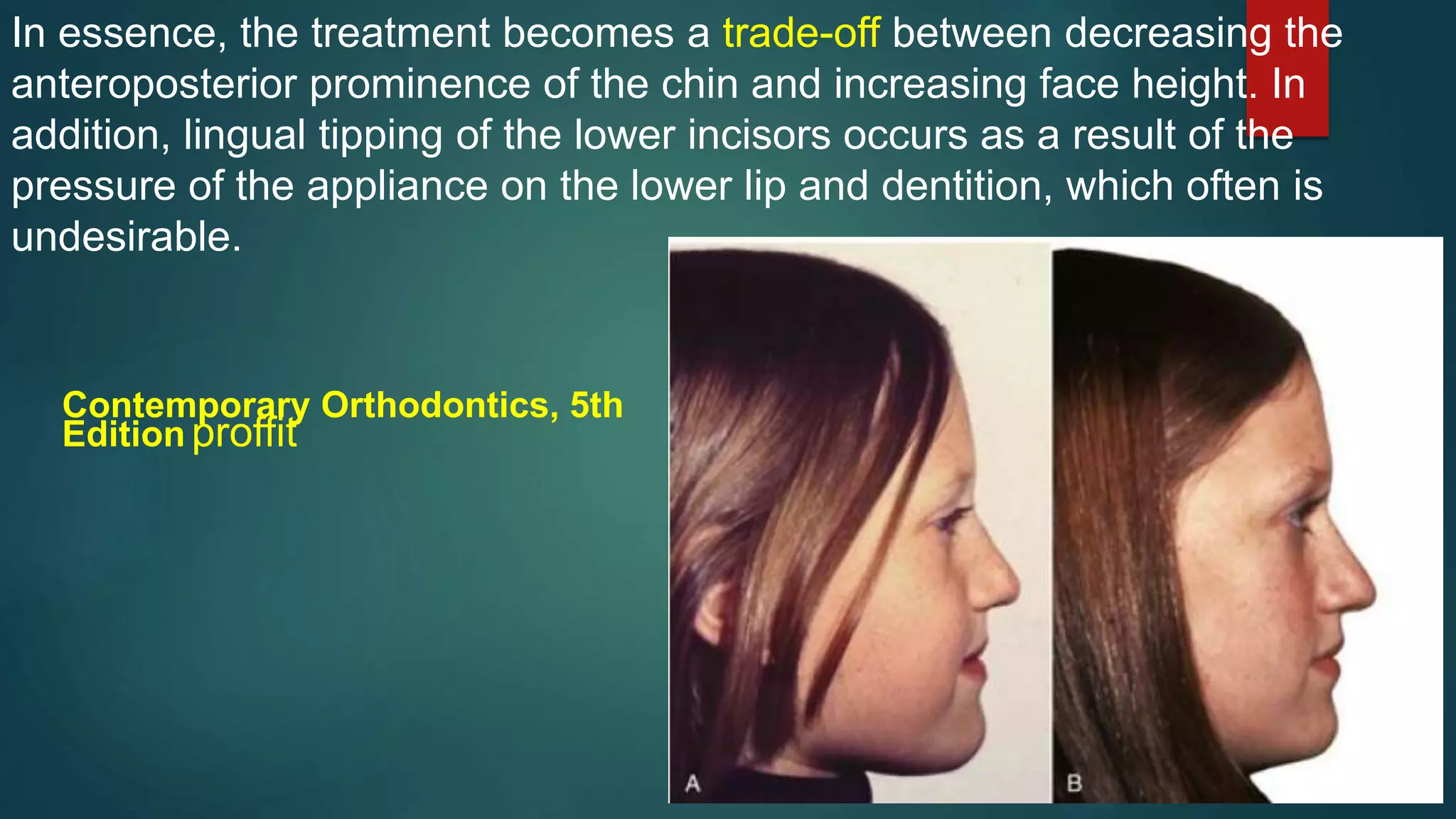 Chin cup for treatment of growing class III patient | PPTX