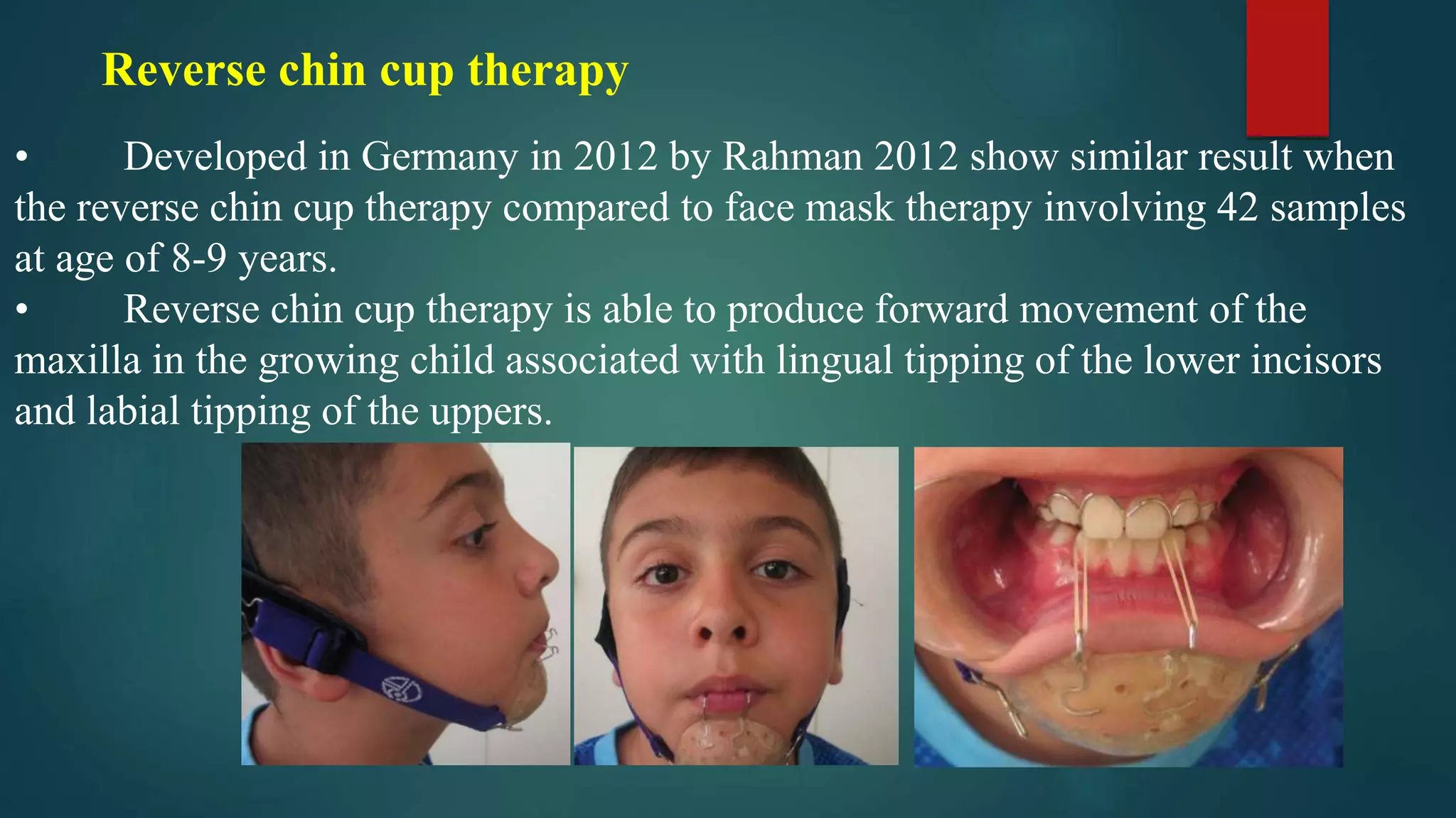 Chin cup for treatment of growing class III patient | PPTX