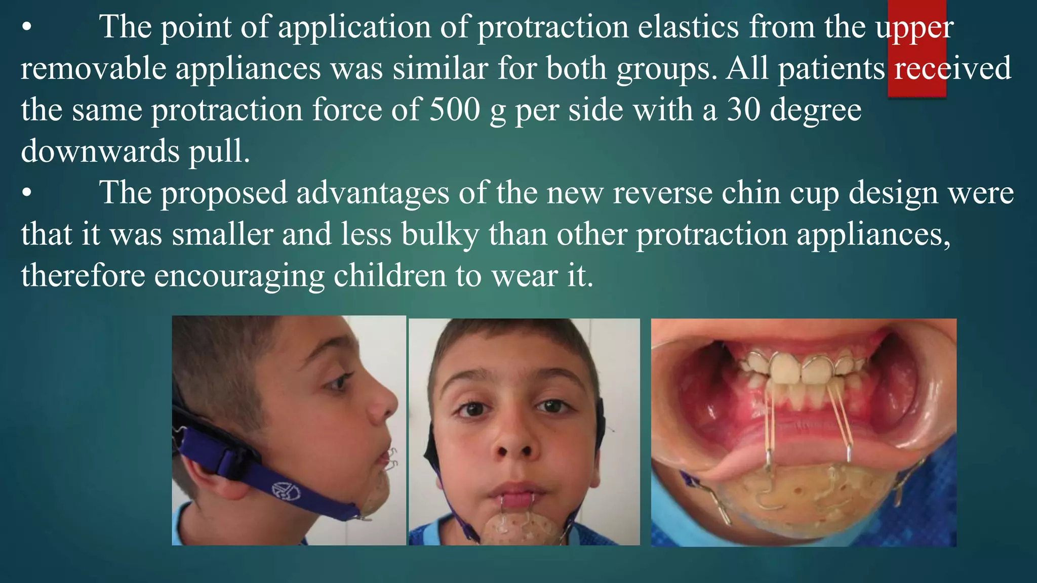 Chin cup for treatment of growing class III patient | PPTX
