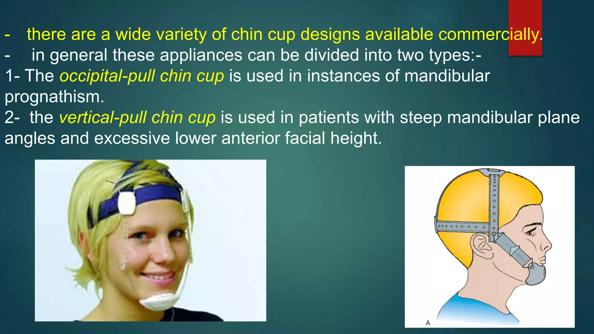 Chin cup for treatment of growing class III patient | PPTX