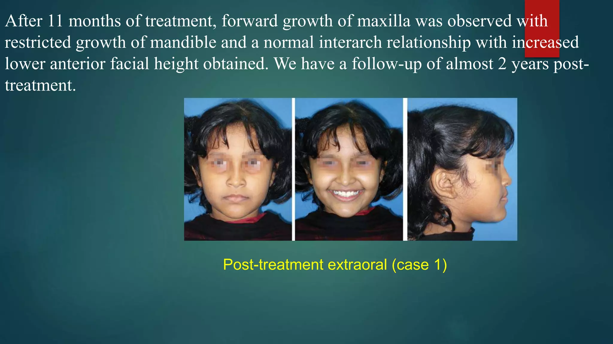 Chin cup for treatment of growing class III patient | PPTX
