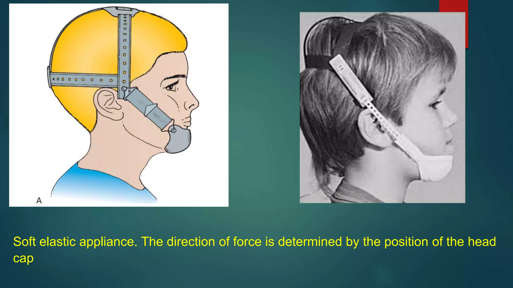 Chin cup for treatment of growing class III patient | PPTX