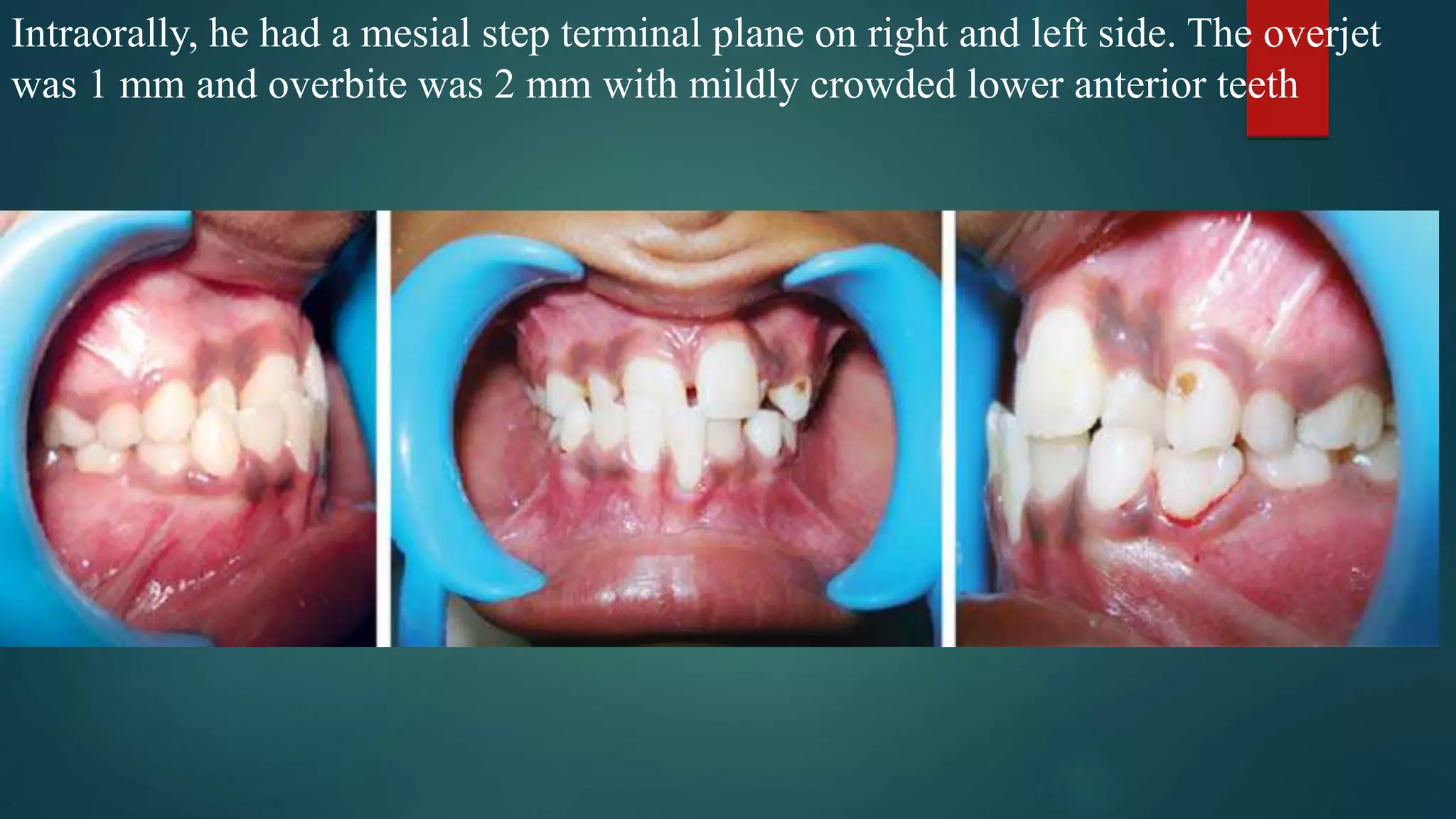 Chin cup for treatment of growing class III patient | PPTX