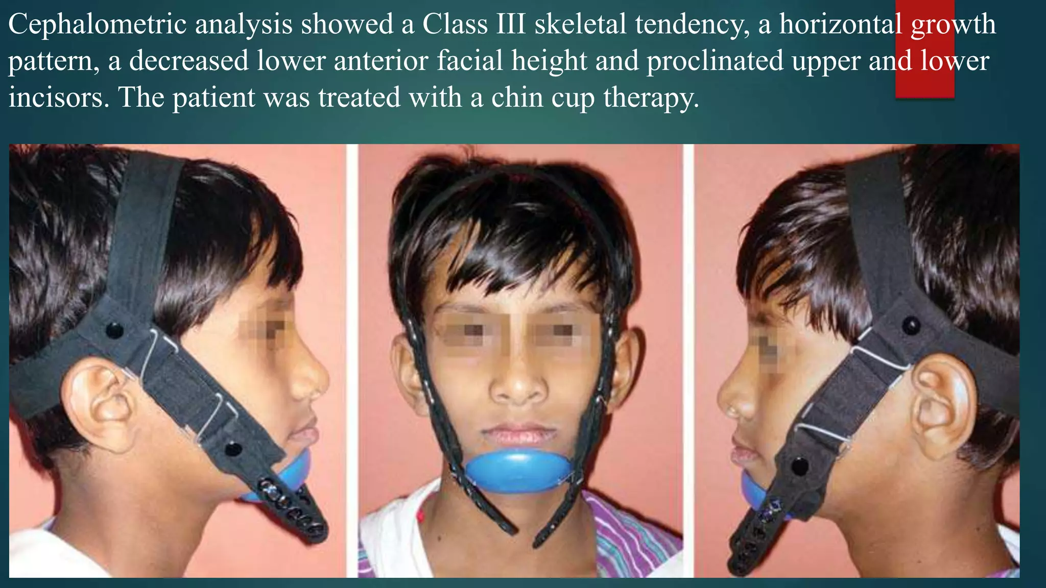 Chin cup for treatment of growing class III patient | PPTX