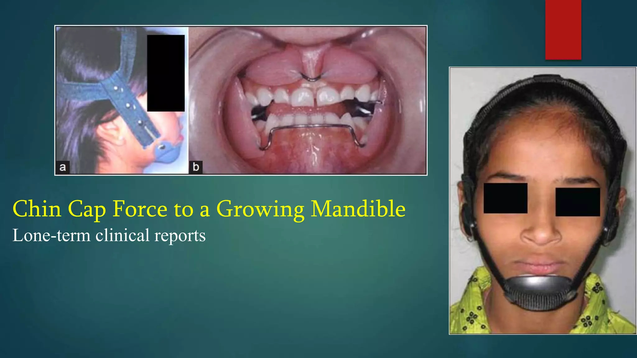 Chin cup for treatment of growing class III patient | PPTX