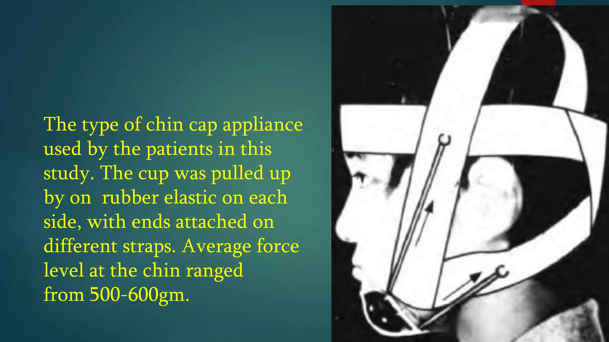 Chin cup for treatment of growing class III patient | PPTX