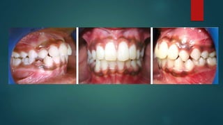 Chin cup for treatment of growing class III patient | PPTX