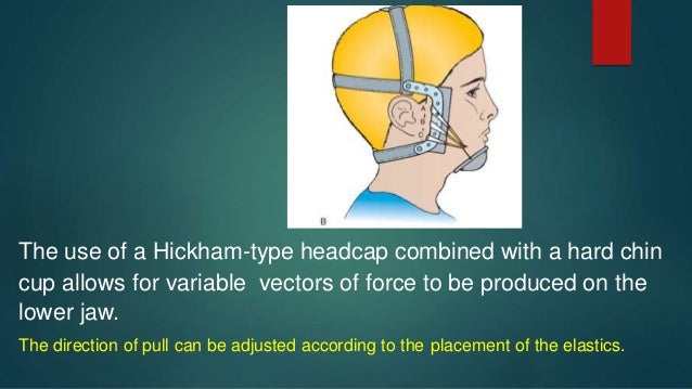 Chin cup for treatment of growing class III patient