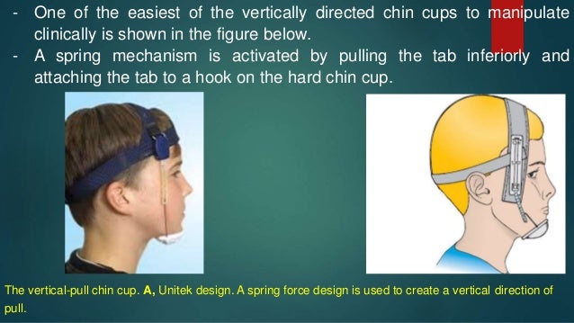 Chin cup for treatment of growing class III patient